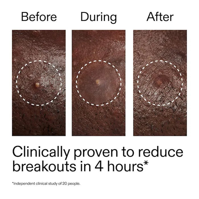 The Inkey LIST Hydrocolloid Invisible Pimple Patches 22 Patches ...